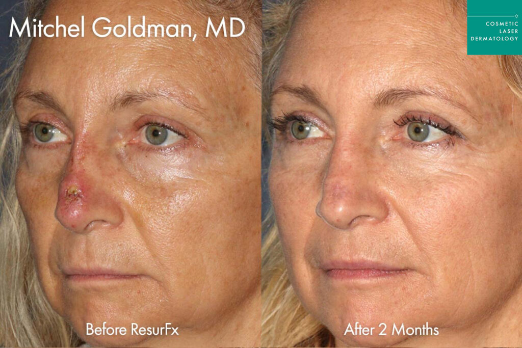 ResurFX Skin Resurfacing - Glick Skin Institute